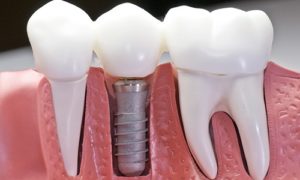 Titanium Dental Implants - Shanti Dentals | Benefits of Dental Implants